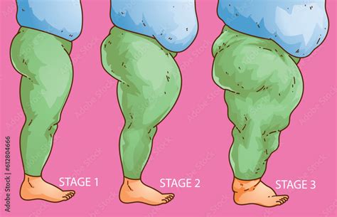 Stages Of The Lipedema Womens Legs With Health Problems Healthcare