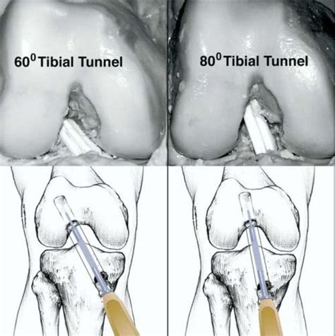 The Key Tunnel In The Transtibial Technique Is The Tibial Tunnel