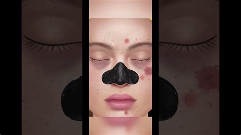 Video Asmr Blackhead Remove On Nose Shorts Shortvideo Short Viral