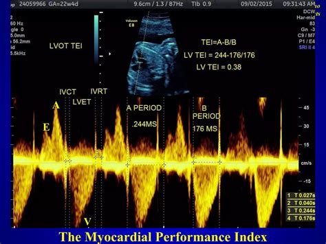 Fetal Echo Measurments Pptx Heart And Cardiovascular Diseases Diseases And Conditions
