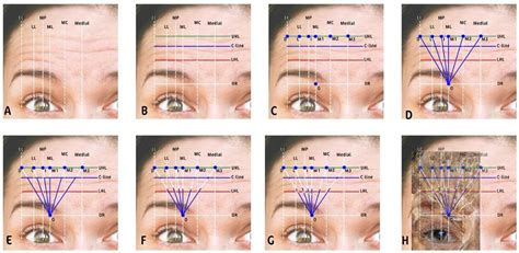 Optimizing Botulinum Toxin A Administration For Forehead Wrinkles Introducing The Lines And