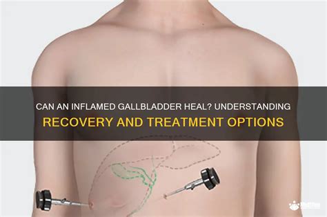 Can An Inflamed Gallbladder Heal Understanding Recovery And Treatment