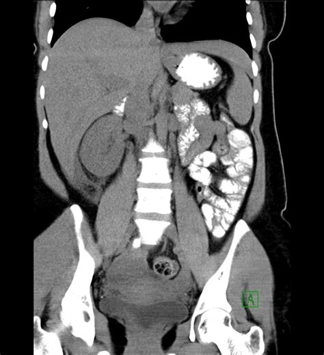 Subhepatic Appendicitis Image