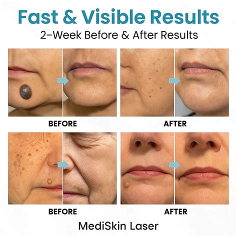 Mediskin Laser Koqon