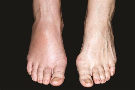 Metatarsal Fracture Swelling