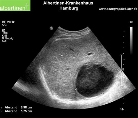 Hemorrhagic Liver Cyst Ultrasound Doccheck