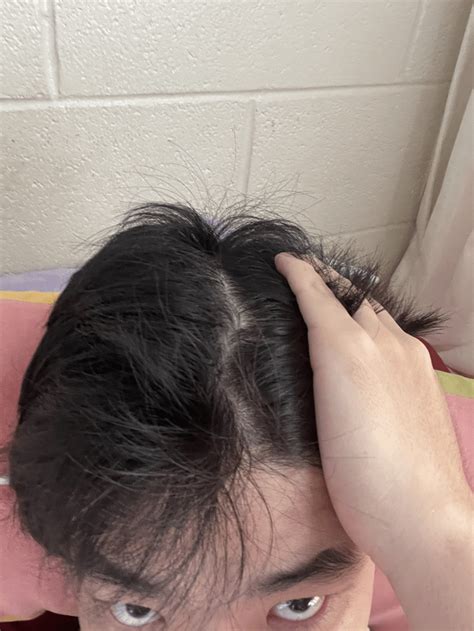 6 Month Diffuse Thinner Update 23yo Korean Rtressless