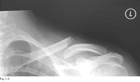 Figure 1 From Trial Midshaft Clavicular Fractures A Multicenter Randomized Clinical