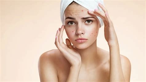 8 Penyebab Jerawat Di Jidat Dan Cara Mengatasinya Hot Liputan6 Com