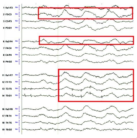 Tracings Showing Abundant Runs Of Slowing Rhythmic Delta Activity With