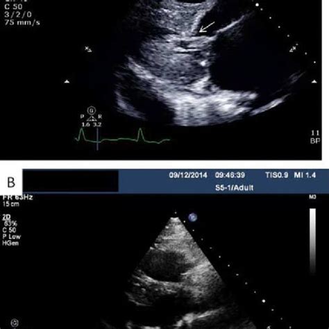 Lv Obstruction Remote To The Outflow Tract Assessed By Transthoracic