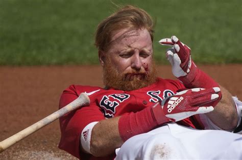 Justin Turner Boston Red Sox Third Baseman Receives 16 Stitches After