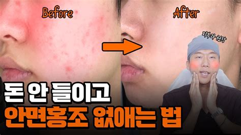 안면홍조 예민피부 무조건 봐야 합니다 Youtube