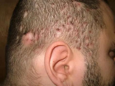 Folliculitis Of The Scalp Causes Symptoms Treatment Diseases And Conditions