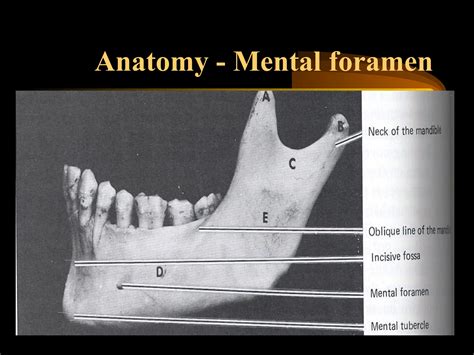 Mandible Fracture Signs And Symptoms Ppt Ppt