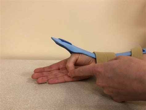Hand Therapy Exercises Following Flexor Pollicis Longus Fpl Repair North Tees And