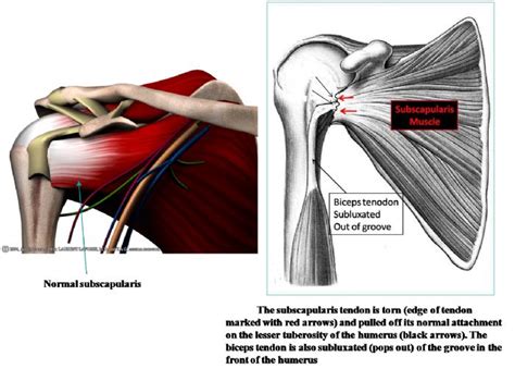 Subscapularis Tendon Injuries Boston Shoulder Institute
