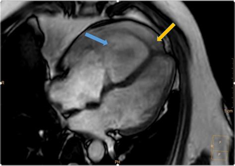 An Unusual Case Of Ebsteins Anomaly In Cmr Journal Of Cardiovascular Magnetic Resonance