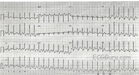 Atrial Flutter With 2 1 Conduction Ecg Guru Instructor Resources