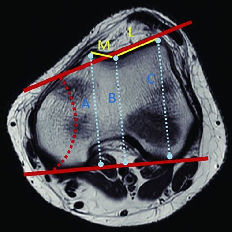 Lateral Trochlear Inclination Angle Trochlear Facet Asymmetry And