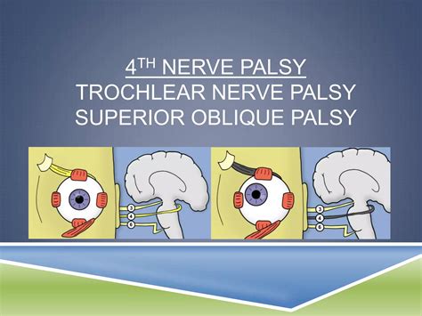 Iv Nerve Palsy Fourth Nerve Palsy Causes Qgbr
