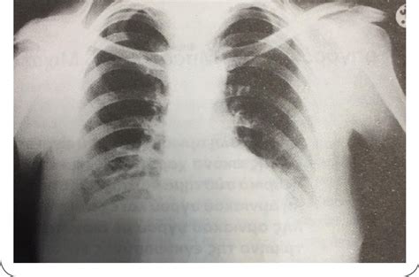 Patient 1 Chest X Ray On The Day Of Release From The Icu Download