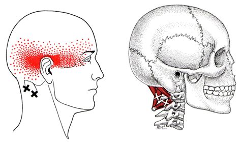 Suboccipital Group The Trigger Point Referred Pain Guide
