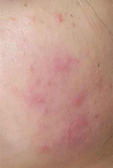Help Please Rskincareaddicts