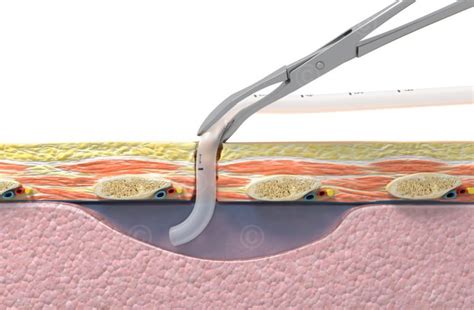 Illustrationen Thoraxdrainage Medicalgraphics
