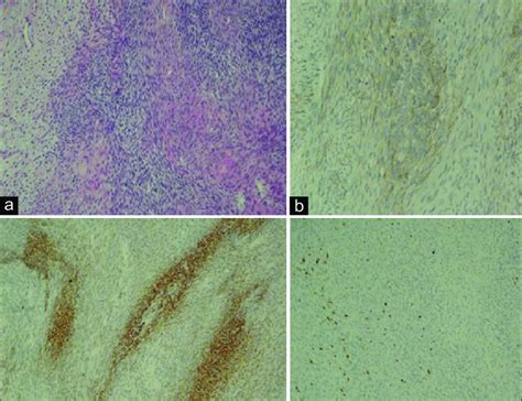 Pathologic Findings Of The Ovarian Fibrothecoma The Tumor Cells Are