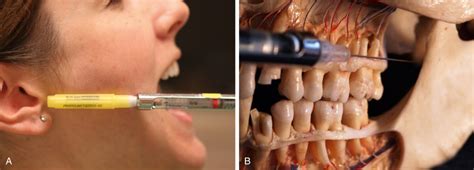 Local Anesthesia Pocket Dentistry