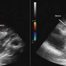 Coil Embolization Of PDA Using Gianturco Non Detachable Coil As First Download Scientific