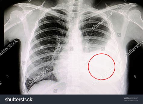 Tuberculosis X Ray Film