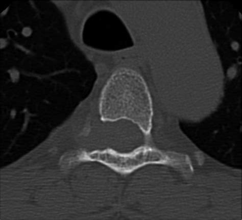 Infiltrating Spinal Angiolipoma Pmc
