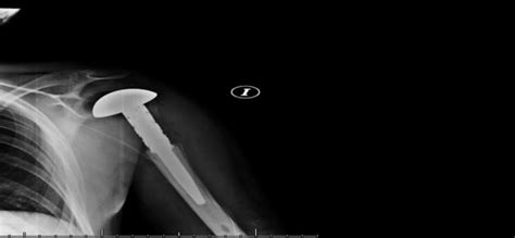 Marginal Tumor Resection With Partial Tumor Prosthesis Reconstruction