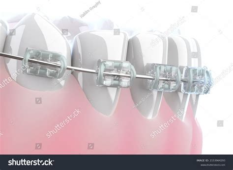 Teeth Braces Brackets Open Human Mouth Stock Illustration 2153964293