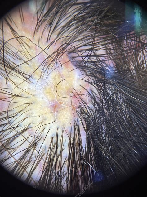 Dissecting Cellulitis Dermoscopy Stock Image C059 6842 Science