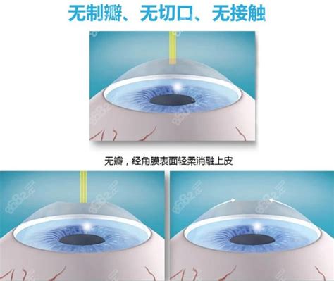 全激光smart和全飞秒哪个好smart和全飞秒近视手术各有优缺点近视眼矫正 8682整形网