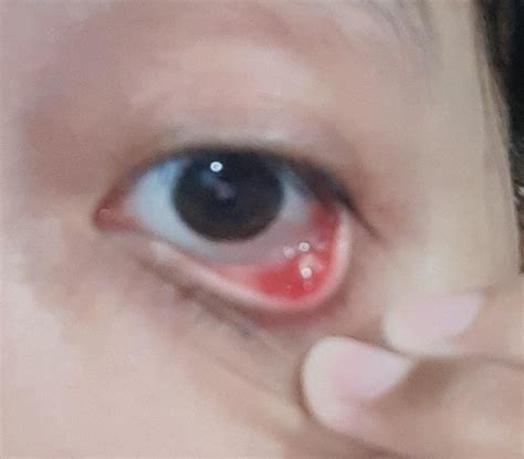 Internal Stye Lower Eyelid About To Pop R Blepharitis