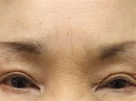 Forehead Brow Lift Oculofacial Clinic Tokyo Ginza Oculoplastic Surgery