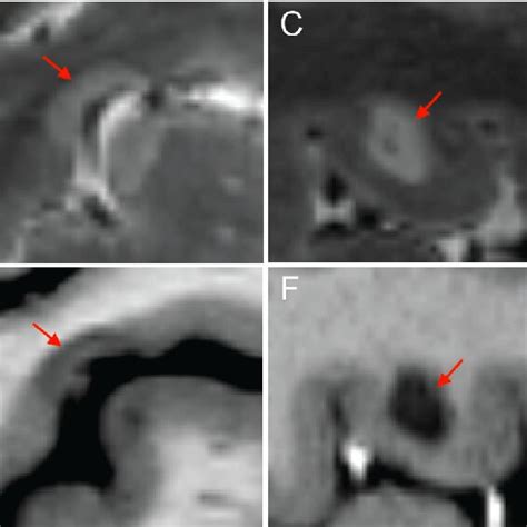 Topography And Imaging Appearance Of Cortical Lesions A Cortical