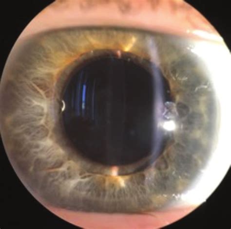 Iris Optic Capture Graph 1 Contrast Sensitivity Download Scientific Diagram