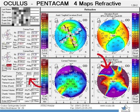 [video] Marta Calatayud On Linkedin Cornea Ophthalmology Topography Pentacam Pupil Help