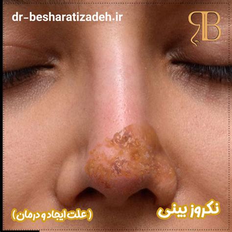 نکروز بینی از علت تا درمان علائم اولیه نکروز بینی