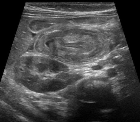 Target Sign Intussusception Usg The Appearance Is Generated By Concentric Alternating