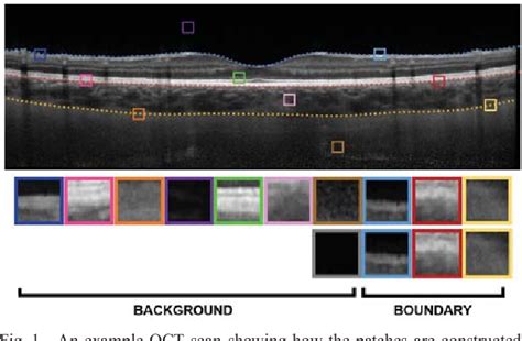 Figure 1 From Constructing Synthetic Chorio Retinal Patches Using Generative Adversarial