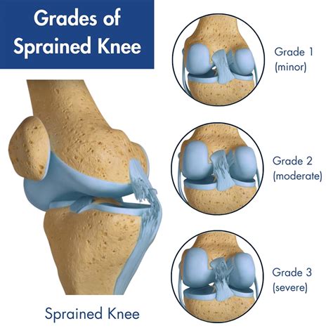 Sprained Knee Posterior Cruciate Ligament Pcl Injury Symptoms
