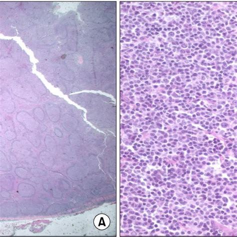 Pathologic Findings Of Peripancreatic Lymph Nodes A It Showed Download Scientific Diagram
