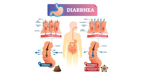 Diarrhoea Symptoms Causes Prevention And Treatments