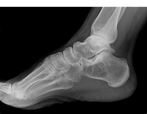 Figure 2 From Intraosseous Calcaneal Lipoma With Subtalar Perforation Through Cystic